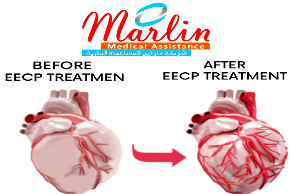 Enhanced External Counter Pulsation | Marlin Medical Assistance